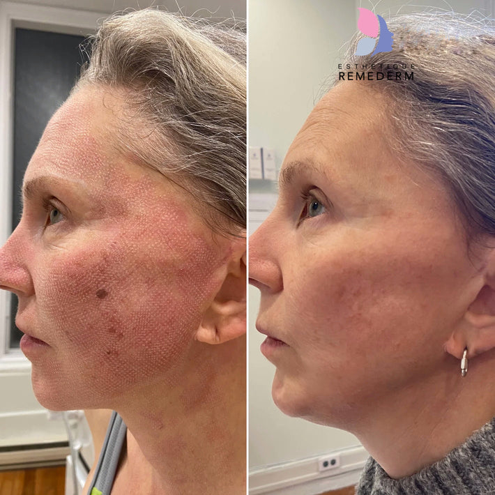 Advanced Fractional Resurfacing Laser Treatments | Remederm Montreal ...
